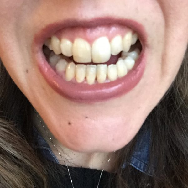 My Invisalign Journey (REVISION Trays 1-18) and Progression Photos ...