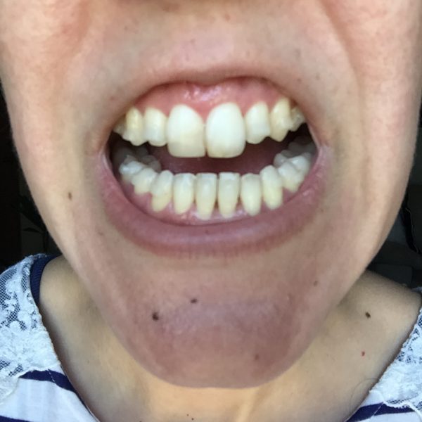 My Invisalign Journey (Revision Trays 1-24) and Progression Photos ...