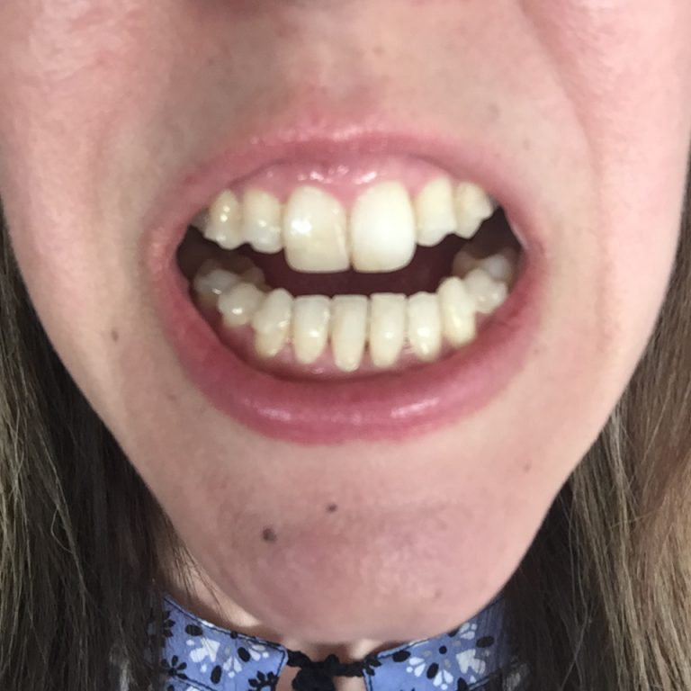 My Invisalign Journey (Revision Trays 1-24) and Progression Photos ...