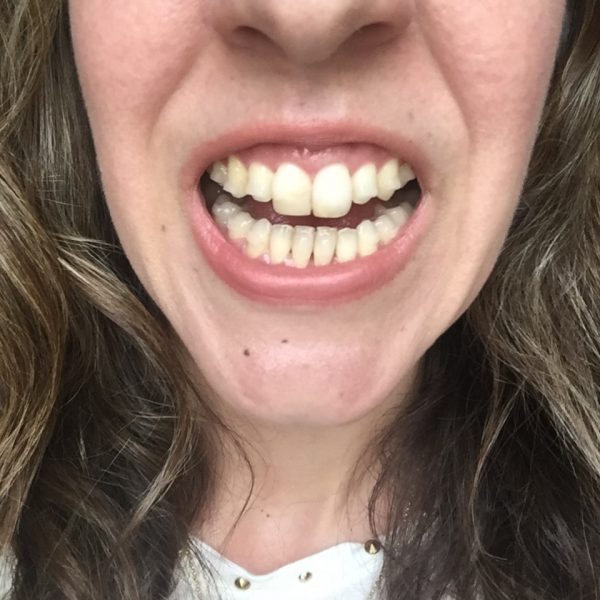 My Invisalign Journey (Revision Trays 1-24) and Progression Photos ...