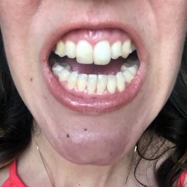My Invisalign Journey (Revision Trays 1-24) and Progression Photos ...