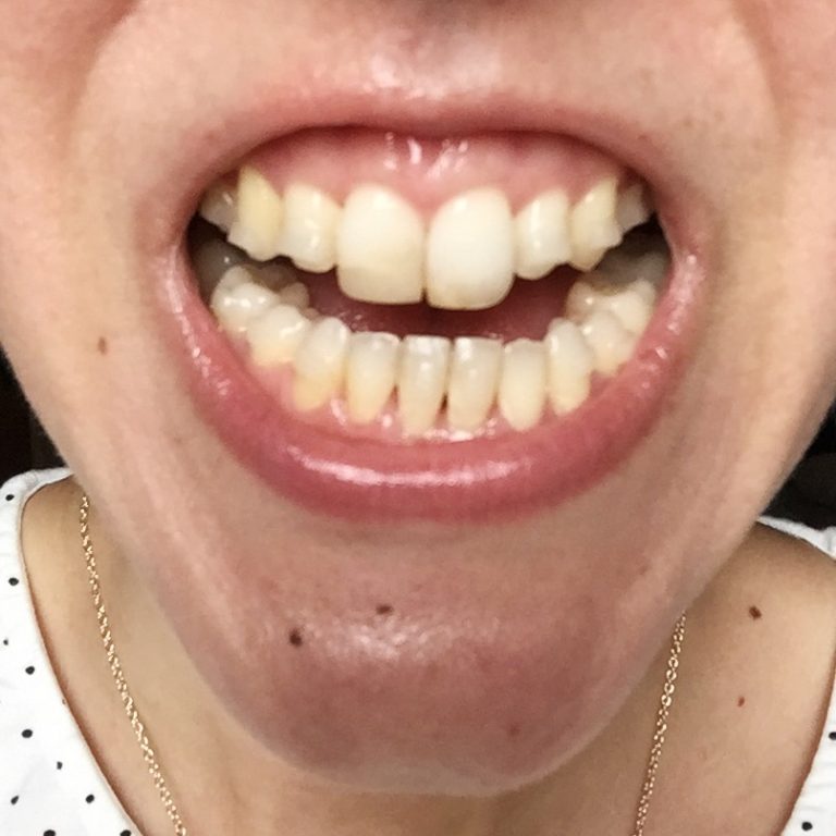 My Invisalign Journey (Revision Trays 1-24) and Progression Photos ...