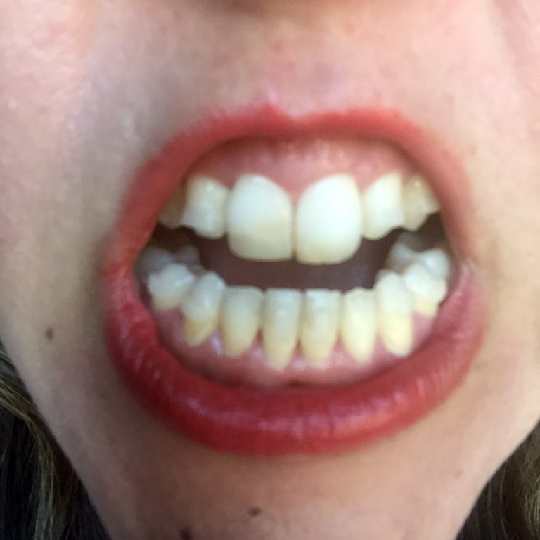 My Invisalign Journey (Revision Trays 1-24) and Progression Photos ...