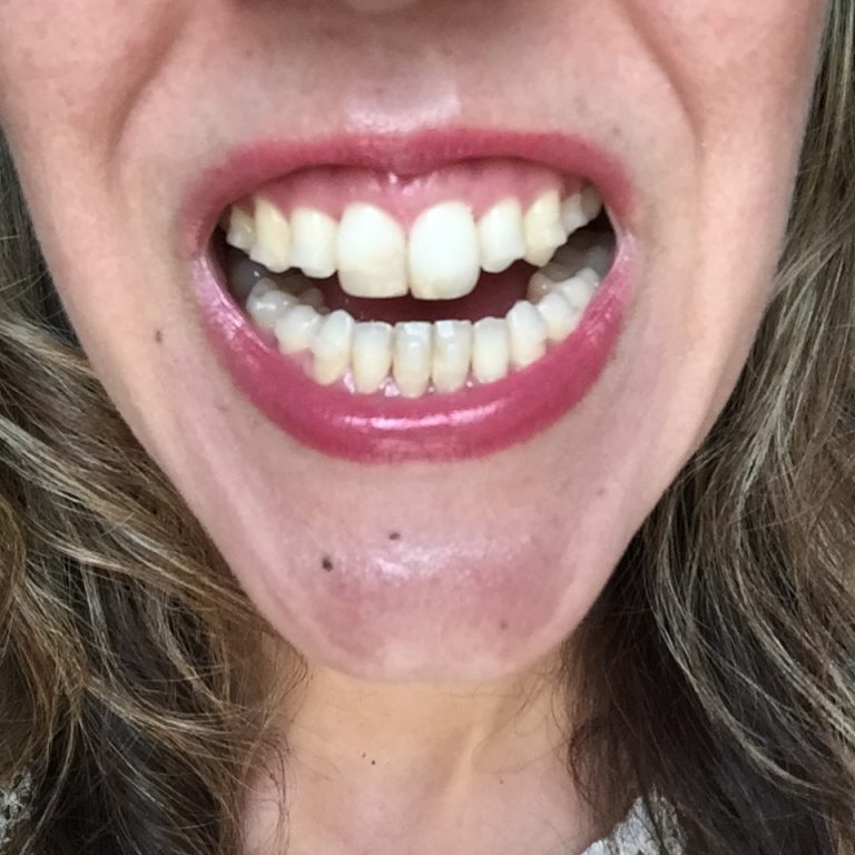 My Invisalign Journey (Revision Trays 1-24) and Progression Photos ...